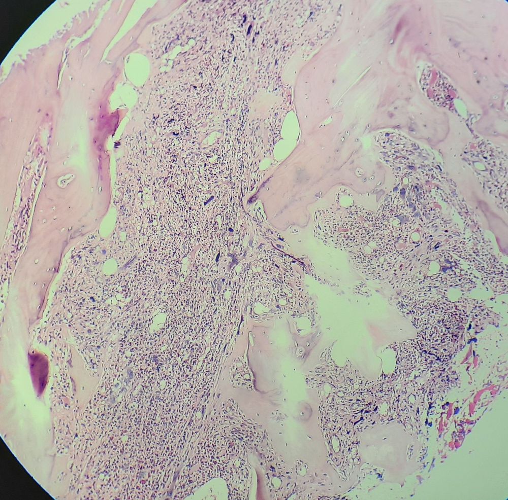 Primary Myelofibrosis - howitreat.in
