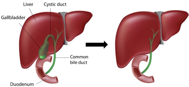 Gallbladder Duct Surgery Complications; Common Hepatic Duct