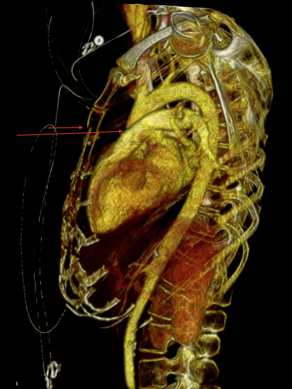 Traumatic Heart Attack Lawsuit