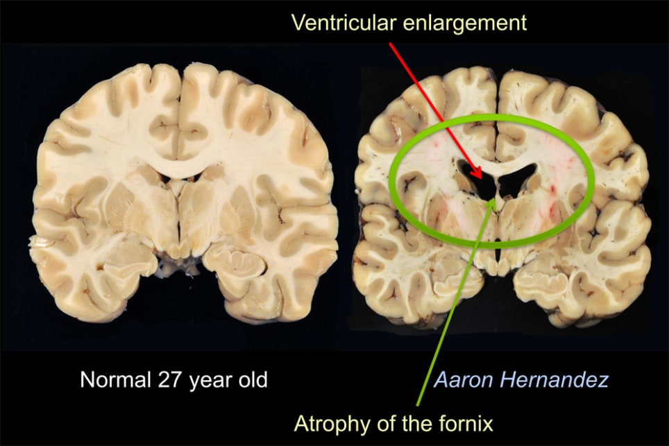 Medical Imaging such as MRI and CT does not detect 80% of brain damage ...