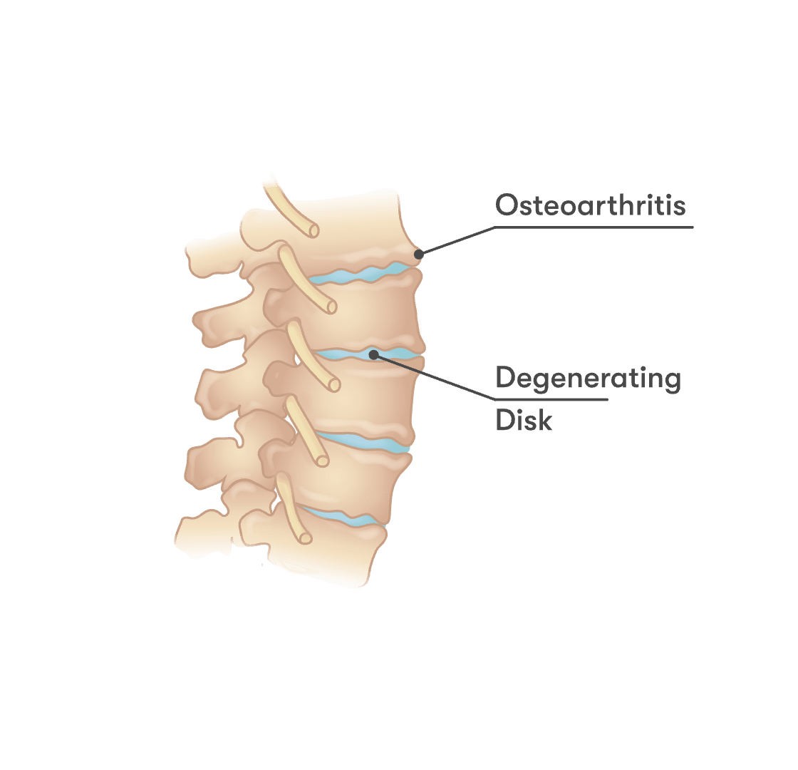 Pinched Shoulder Blade Nerve Symptoms And Pain Relief Pinched Shoulder Blade Nerve Symptoms And Pain Relief
