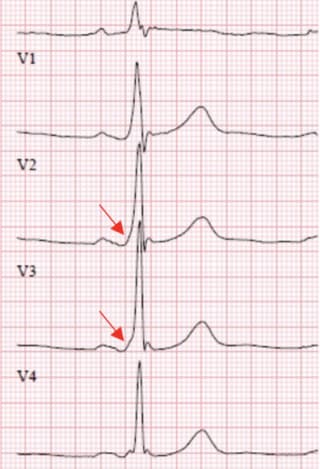 EKG-tolkning – behandlingsöversikt | Internetmedicin