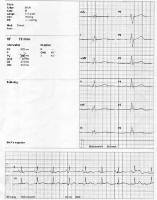 EKG-atlas, normalt EKG