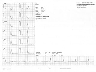 EKG-atlas, retledningshinder