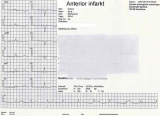 EKG-atlas, infarkt