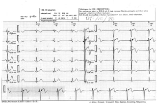EKG-atlas, övriga tillstånd