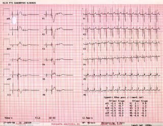 EKG-atlas, övriga tillstånd