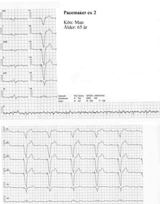 EKG-atlas, övriga tillstånd