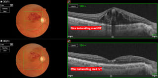 Retinal venocklusion (RVO)