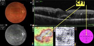 Diabetesmakulaödem (DME)