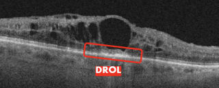 Diabetesmakulaödem (DME)