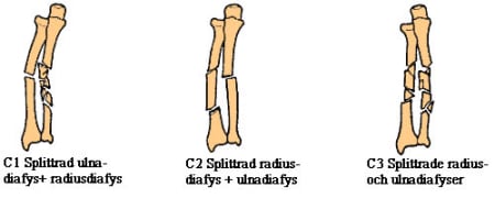 Underarmsfraktur, hos vuxna