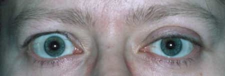 Endokrin oftalmopati