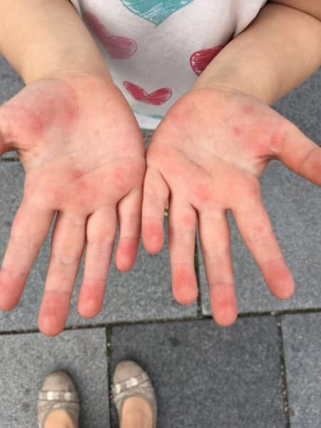 Höstblåsor (Hand, foot and mouth disease) – behandlingsöversikt ...
