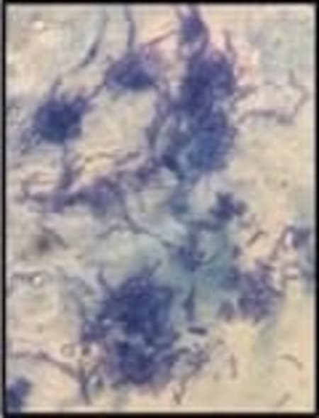 Pityriasis versicolor