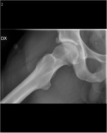 Artroskopi – höft