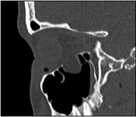 Ansiktstrauma – Orbitafrakturer
