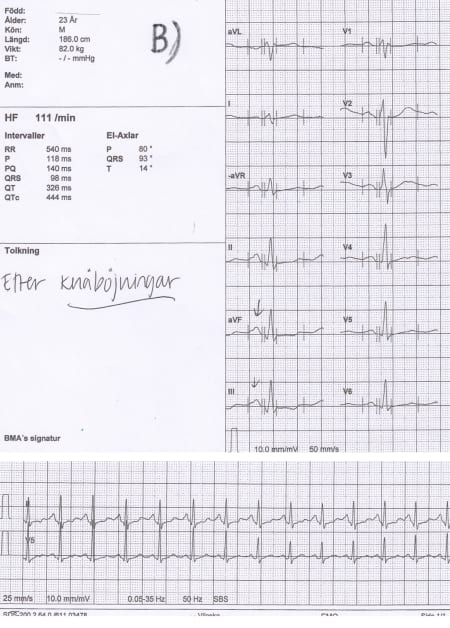 EKG-atlas, övriga tillstånd
