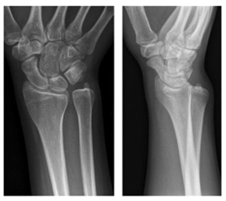 Handledssmärta – behandlingsöversikt | Internetmedicin