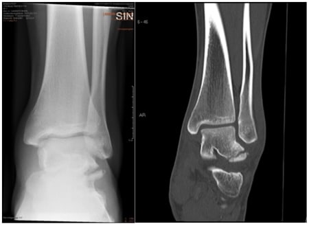 Calcaneus- och talusfrakturer, hos vuxna