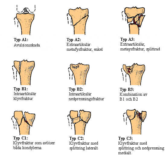 Tibiafraktur, proximal, hos vuxna