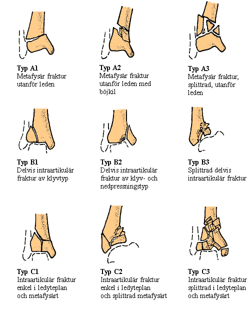 Tibiafraktur, distal, hos vuxna