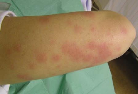 Sweets syndrom (febril neutrofil dermatos)