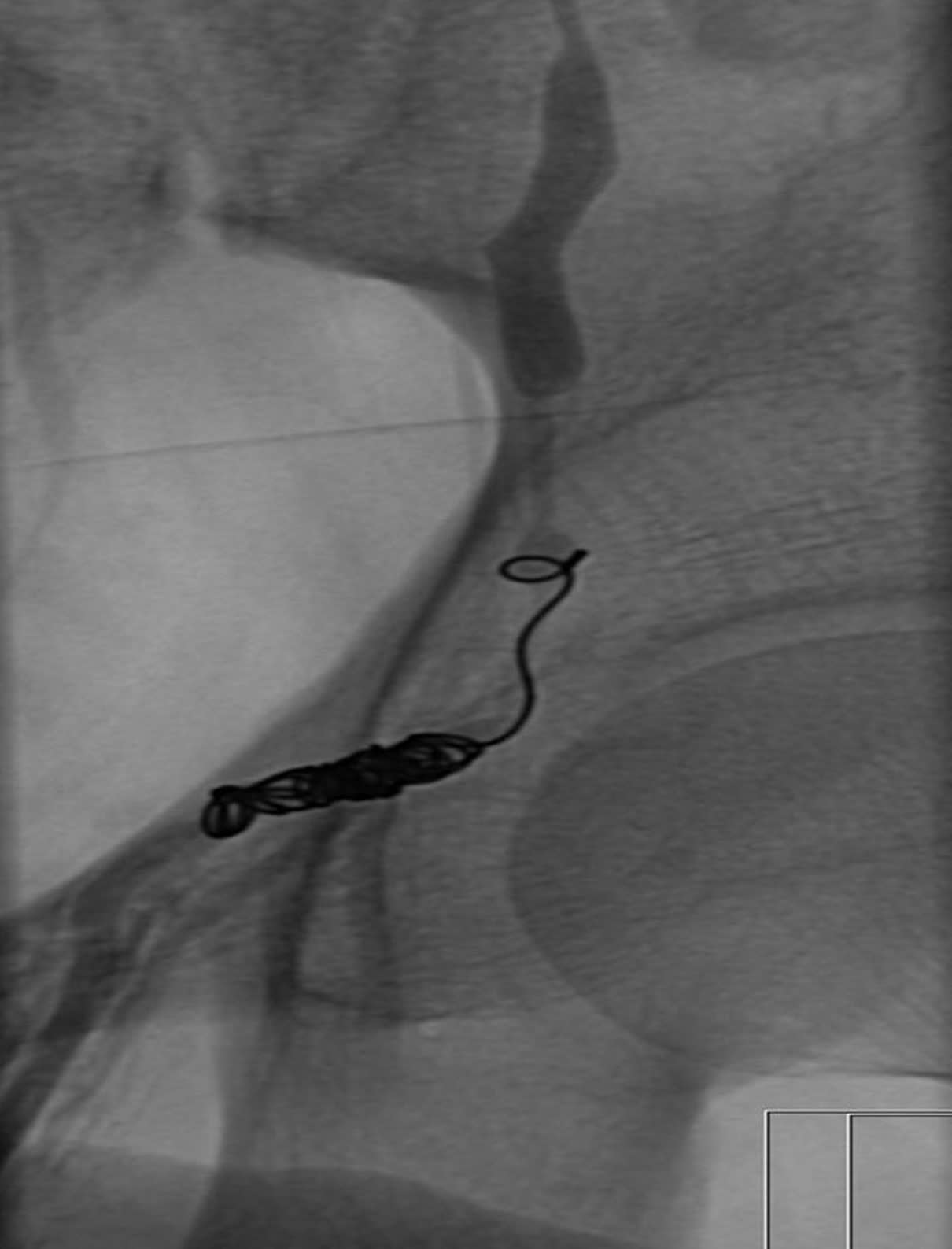 Hydrocele, spermatocele & varikocele