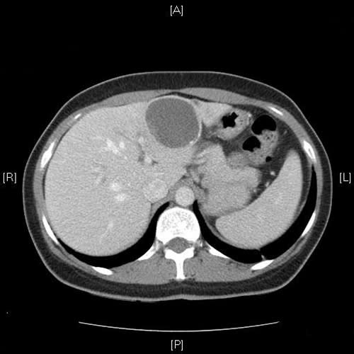 Echinokockos (blåsmasksjuka, dvärgbandmask)