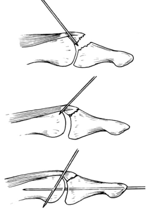 Malletfinger (droppfinger)