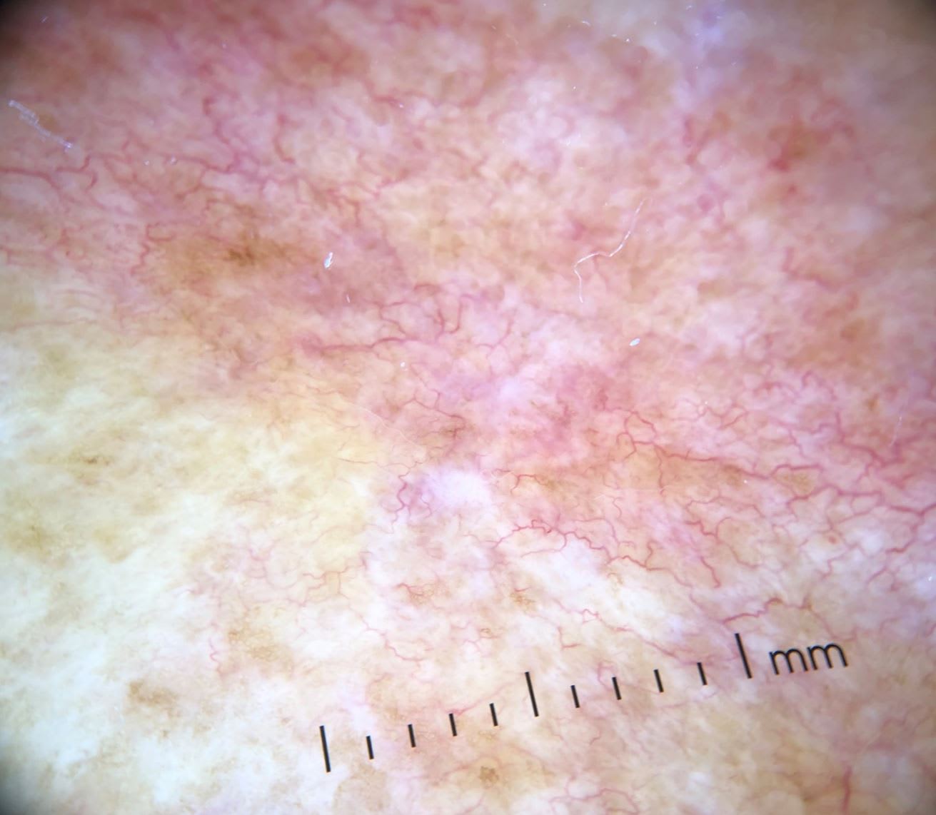 Necrobiosis lipoidica