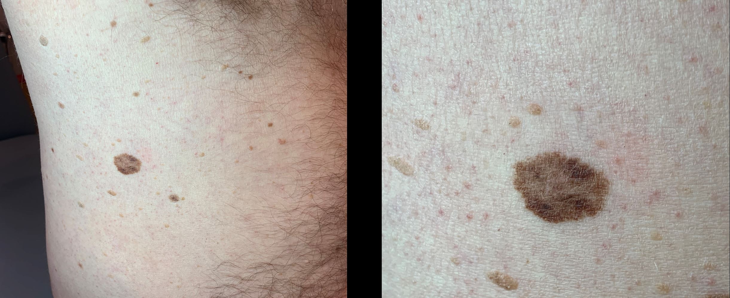 Dermatoskopi – en kort översikt