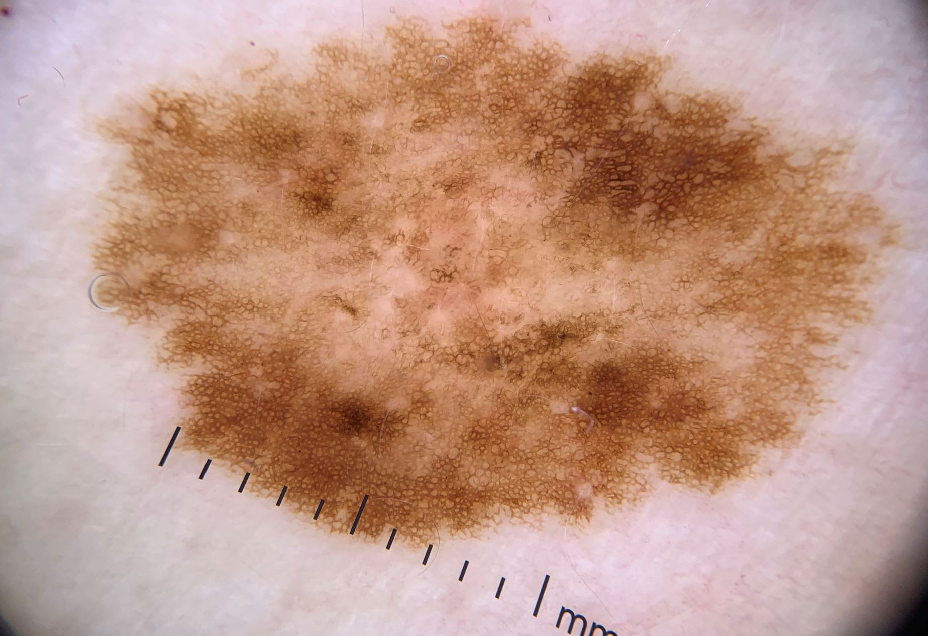 Dermatoskopi – en kort översikt