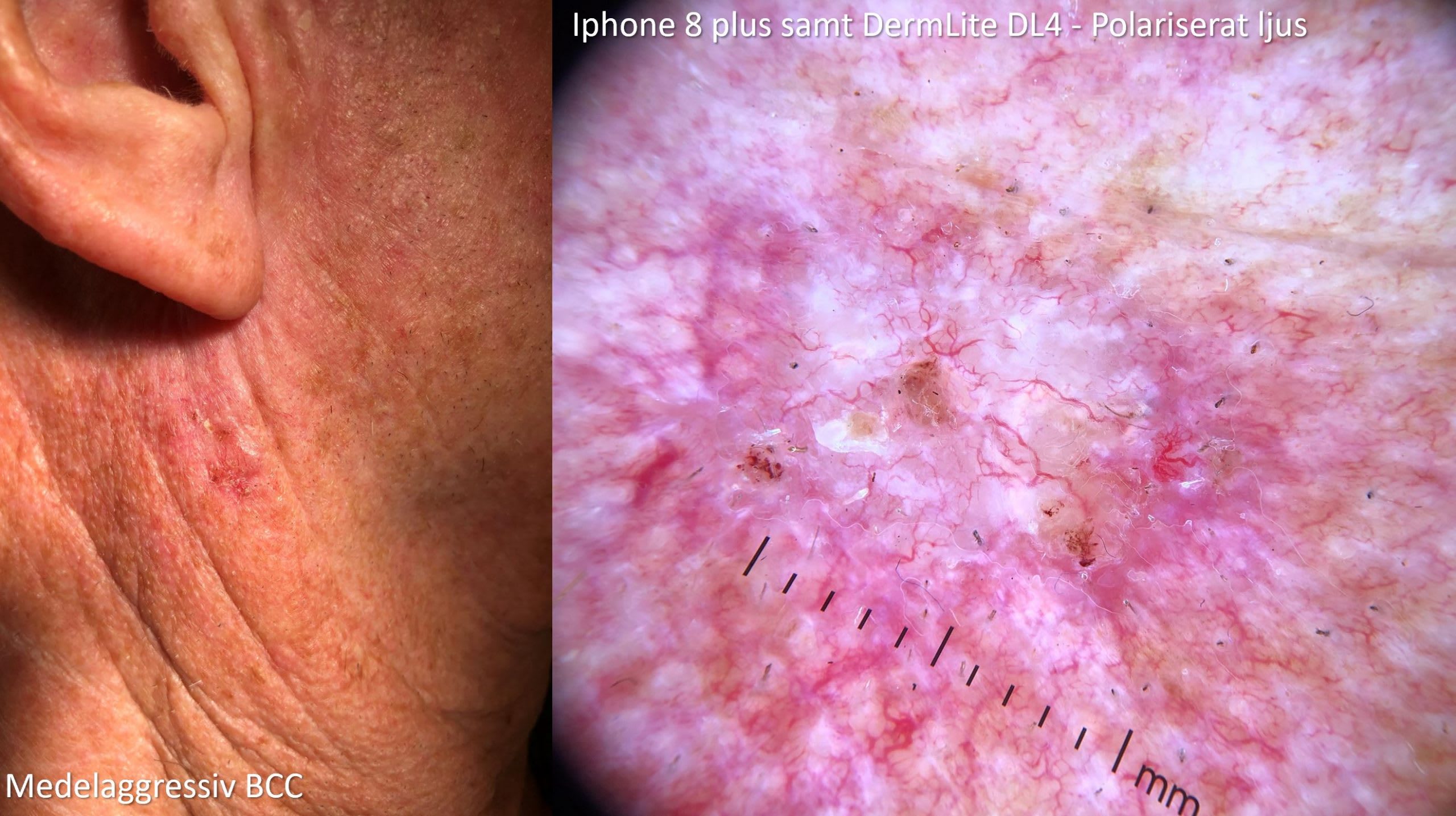 Dermatoskopi – en kort översikt