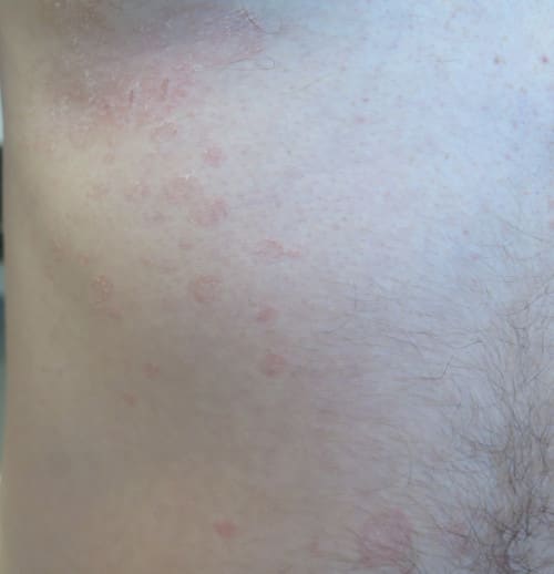 Pityriasis versicolor
