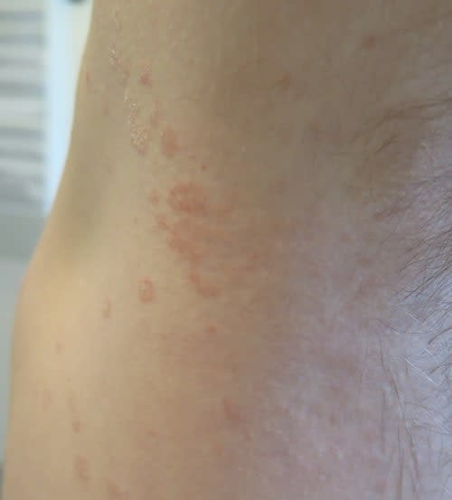 Pityriasis versicolor