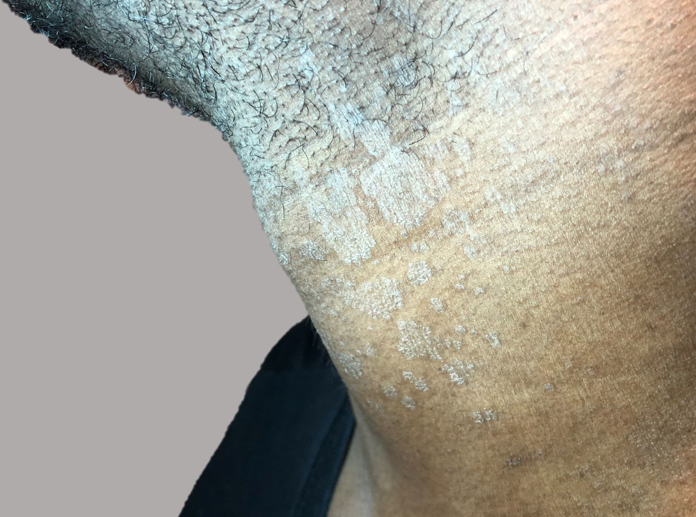 Pityriasis versicolor