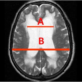Normaltryckshydrocefalus, idiopatisk (iNPH)