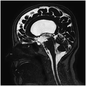 Normaltryckshydrocefalus, idiopatisk (iNPH)