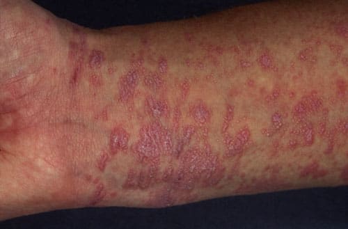 Lichen planus