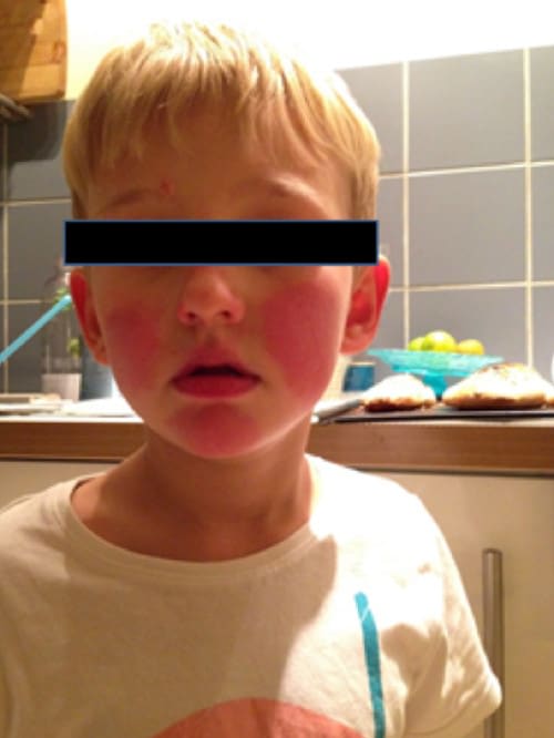 Erythema infectiosum (femte sjukan), Parvovirus B19