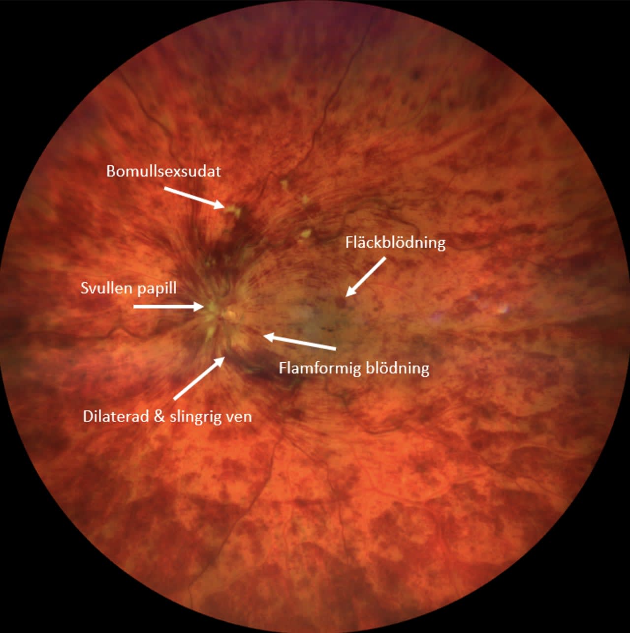 Retinal venocklusion (RVO)