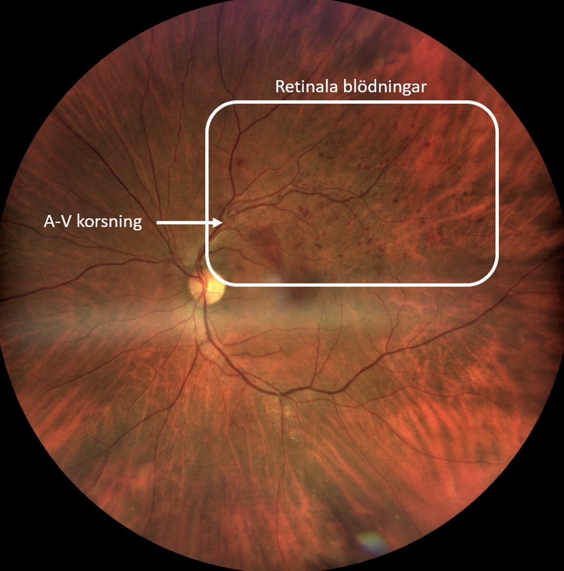 Retinal venocklusion (RVO)