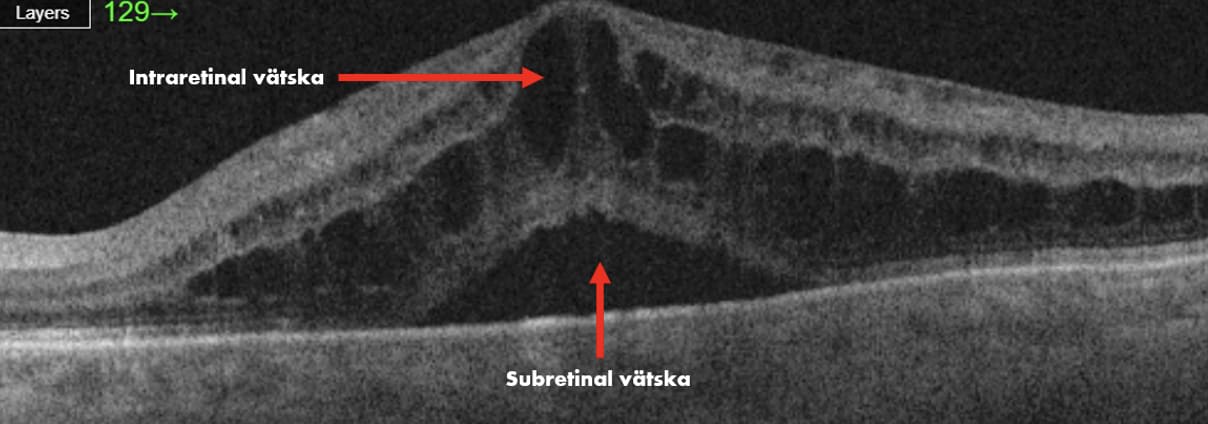 Retinal venocklusion (RVO)