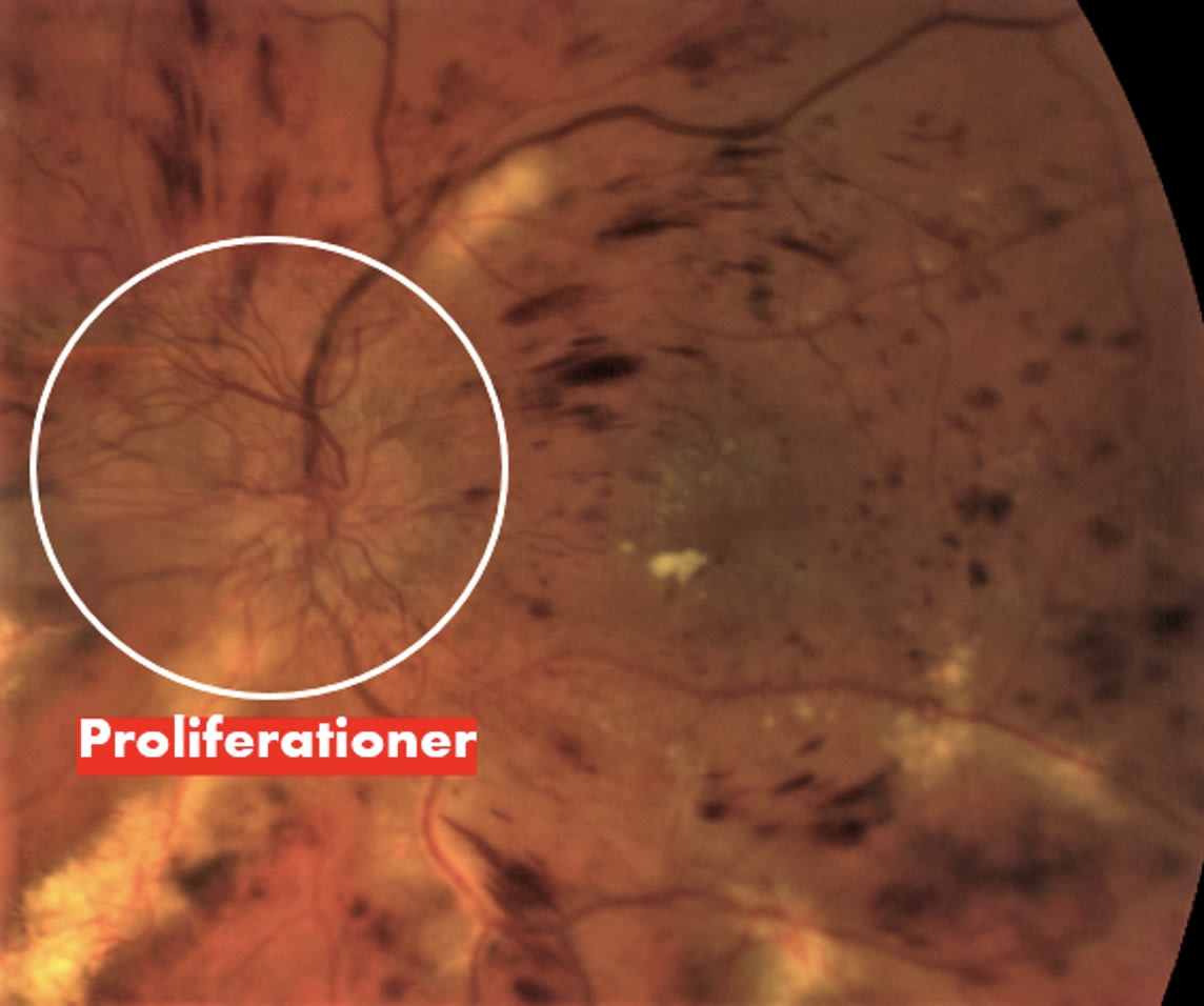 Retinal venocklusion (RVO)