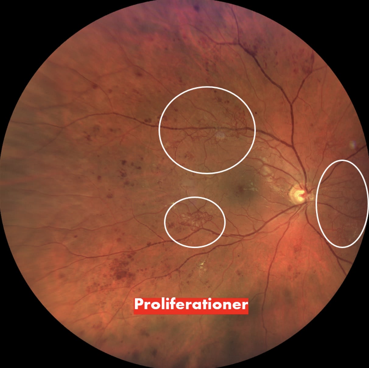 Retinal venocklusion (RVO)