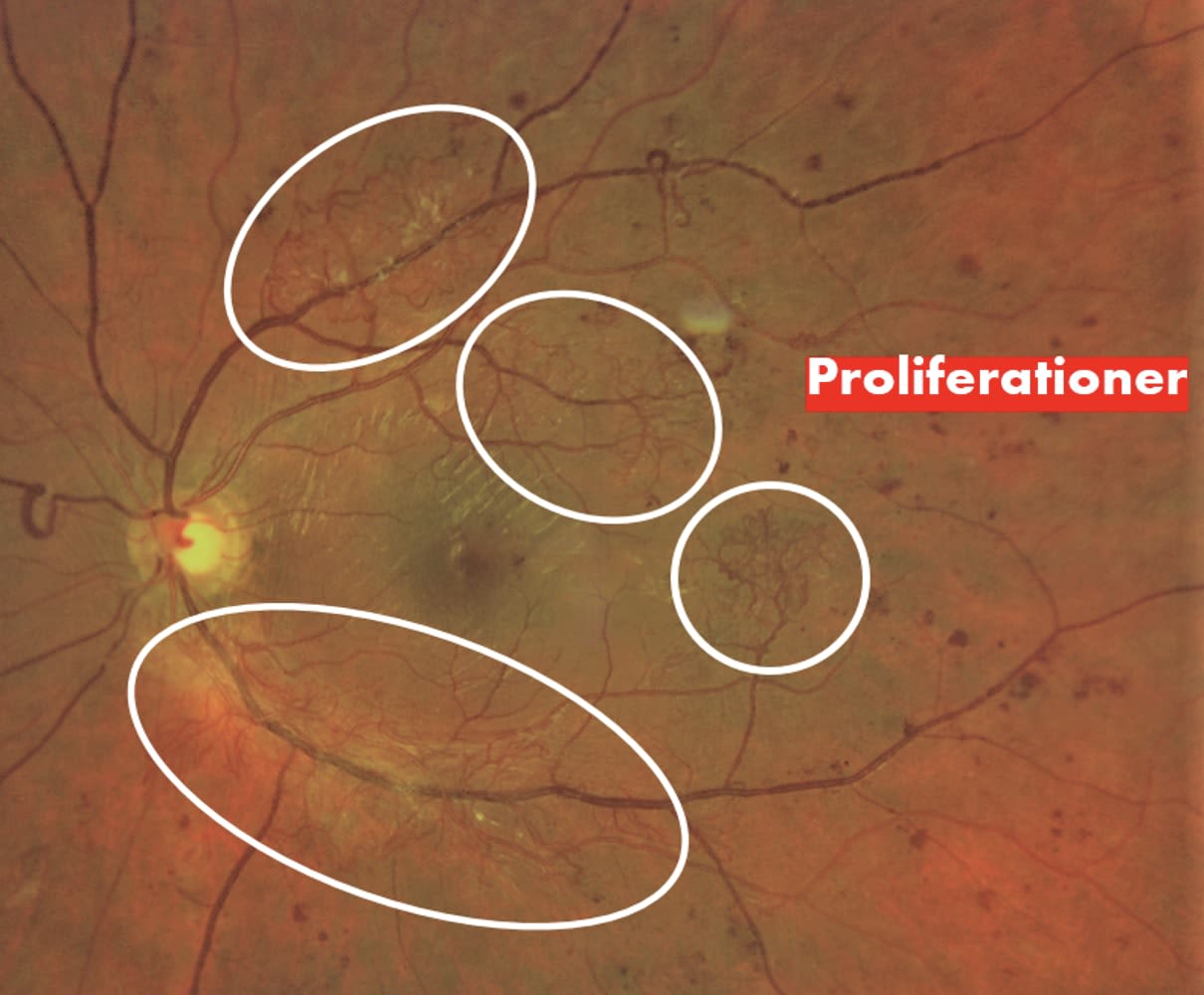 Retinal venocklusion (RVO)