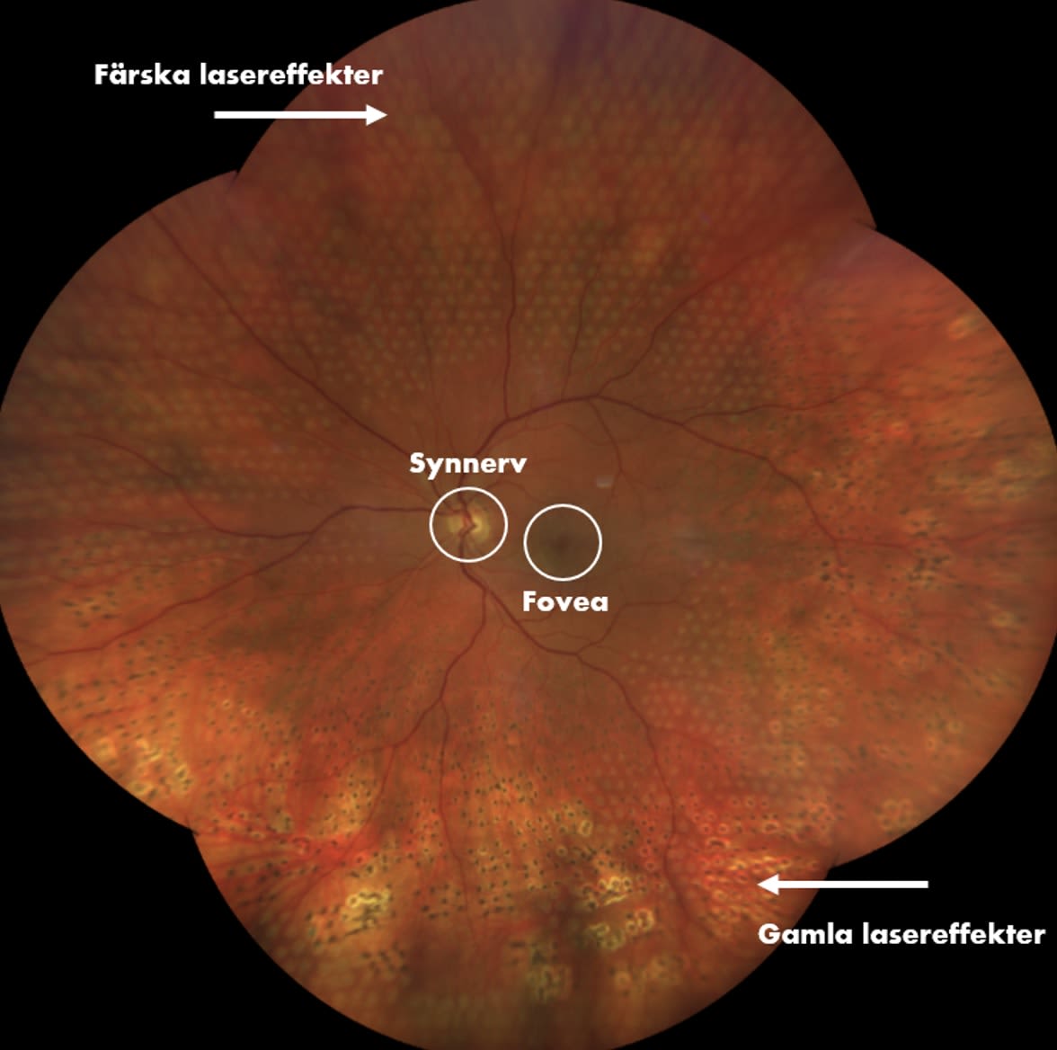 Retinal venocklusion (RVO)