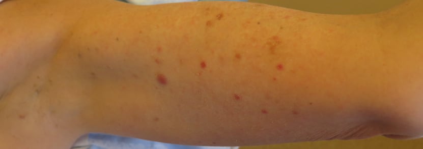 CD30+ lymfoproliferativa sjukdomar: Lymfomatoid papulos och primärt ...