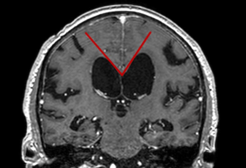 Normaltryckshydrocefalus, idiopatisk (iNPH)